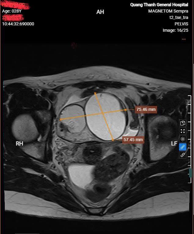CHẨN ĐOÁN CHÍNH XÁC BẰNG CỘNG HƯỞNG TỪ (MRI) 1.5 TESLA – PHẪU THUẬT KỊP ...